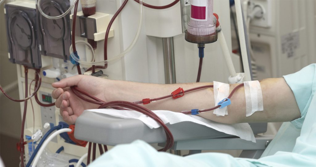 Dialysis Research: Lab-Grown Blood Vessels Might Help – Myhealthyclick.com