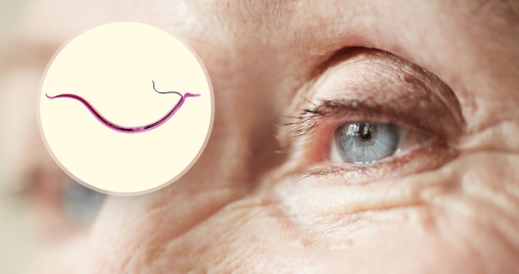 Nebraska Woman Gets Infected By A Rare Parasitic Eye Worm ...